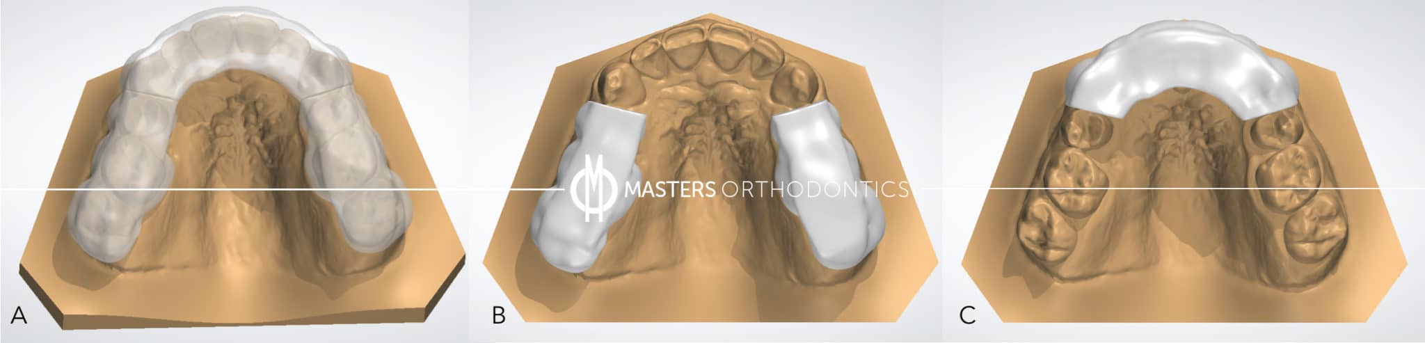 How Occlusal Splints Work For My Practice - Masters Orthodontics